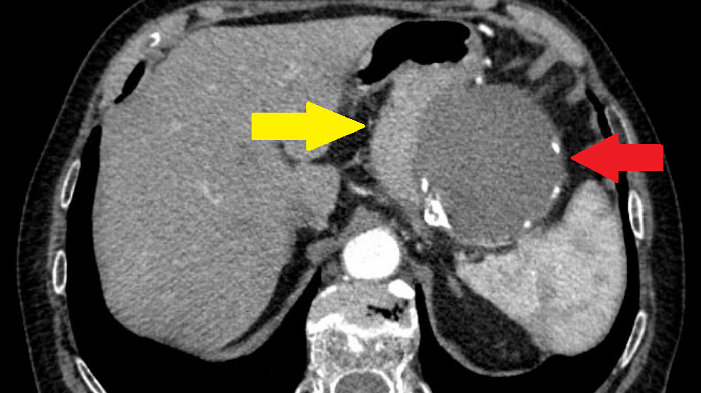 Impression af ventrikelvæg ved gastroskopi kan skyldes gigantisk a ...