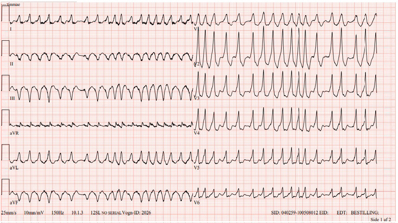 Wolff-Parkinson-Whites syndrom hos midaldrende mand med permanent ...