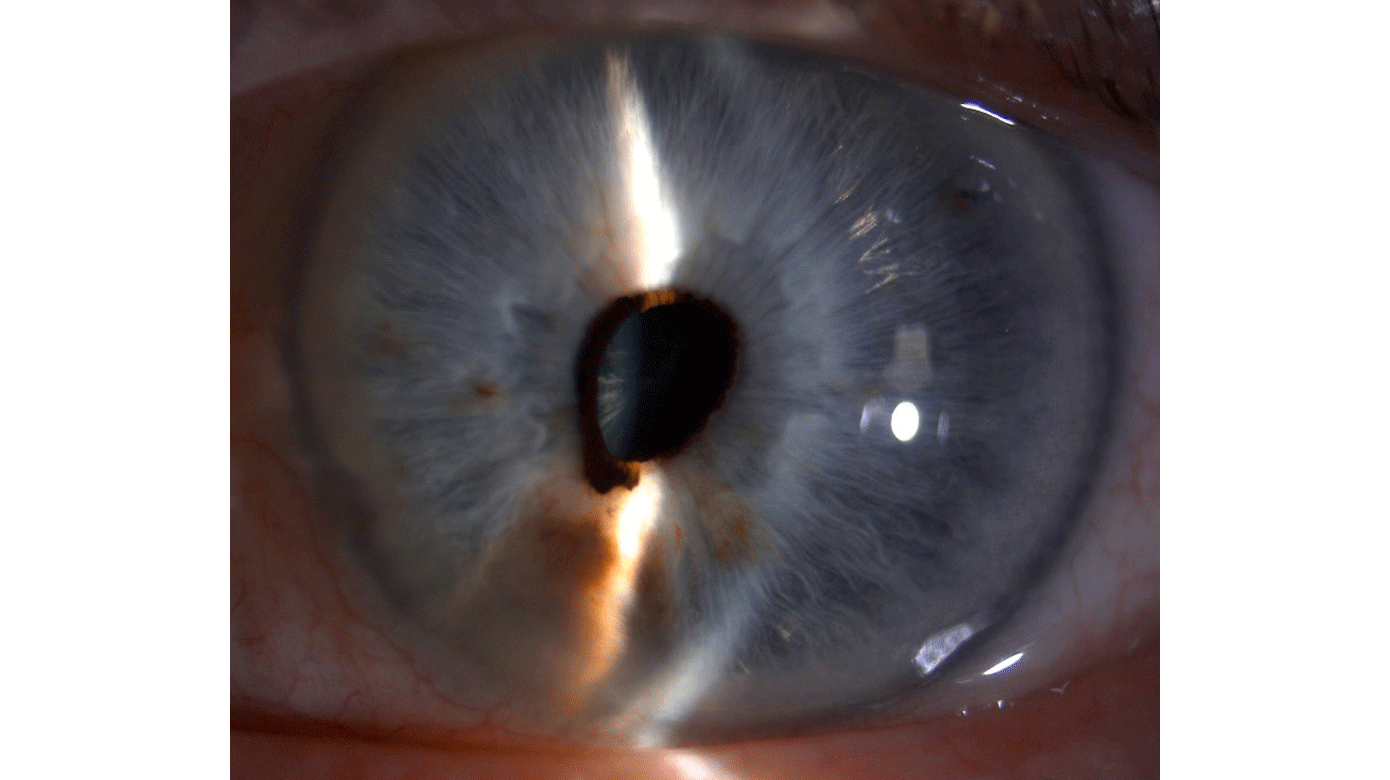 En deform pupil kan skyldes irismelanom | Ugeskriftet.dk