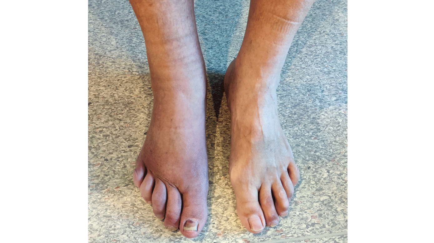 Acrodermatitis chronica atrophicans | Ugeskriftet.dk