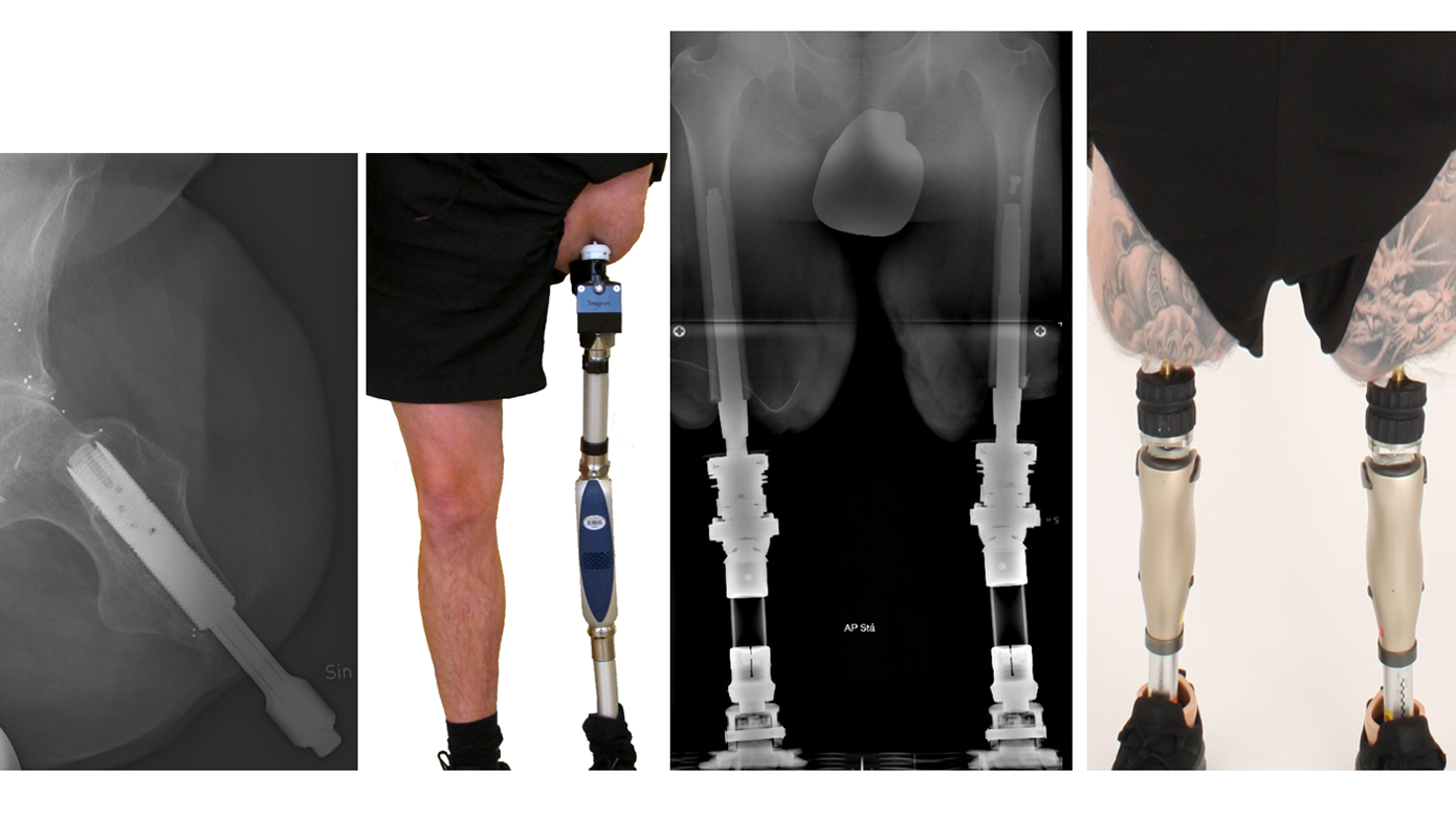 Osseointegrerede proteser til femuramputerede patienter | Ugeskriftet.dk