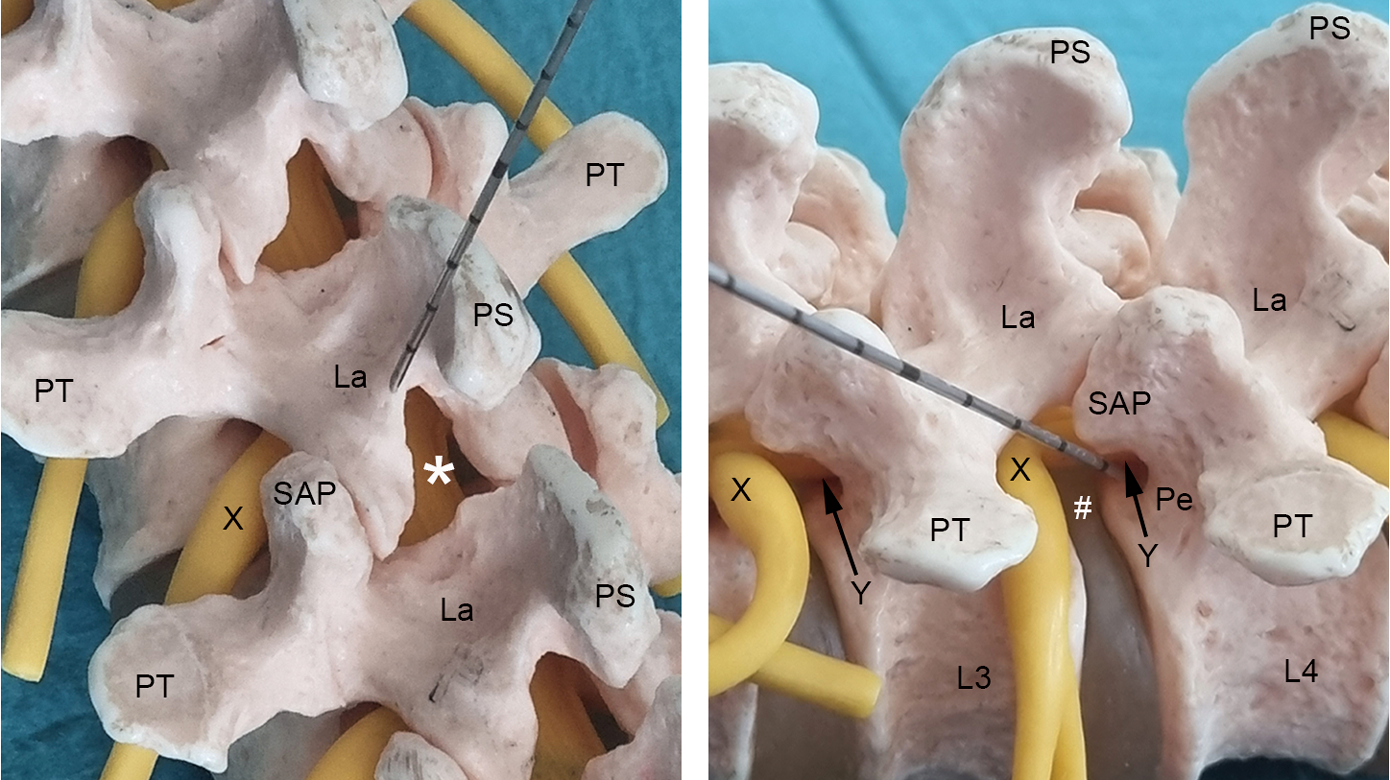 Endoskopisk fjernelse af lumbal discusprolaps | Ugeskriftet.dk