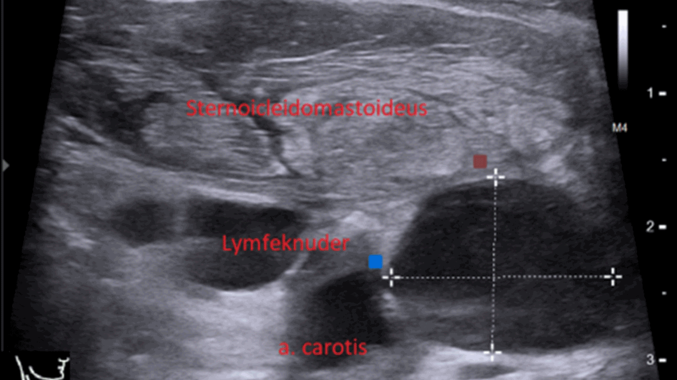 Pyomyositis i m. sternocleidomastoideus | Ugeskriftet.dk