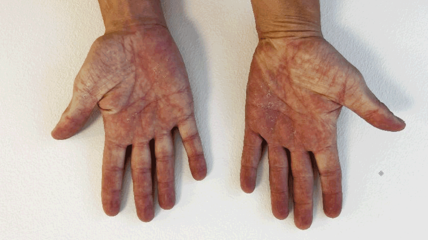 Syfilis | Ugeskriftet.dk