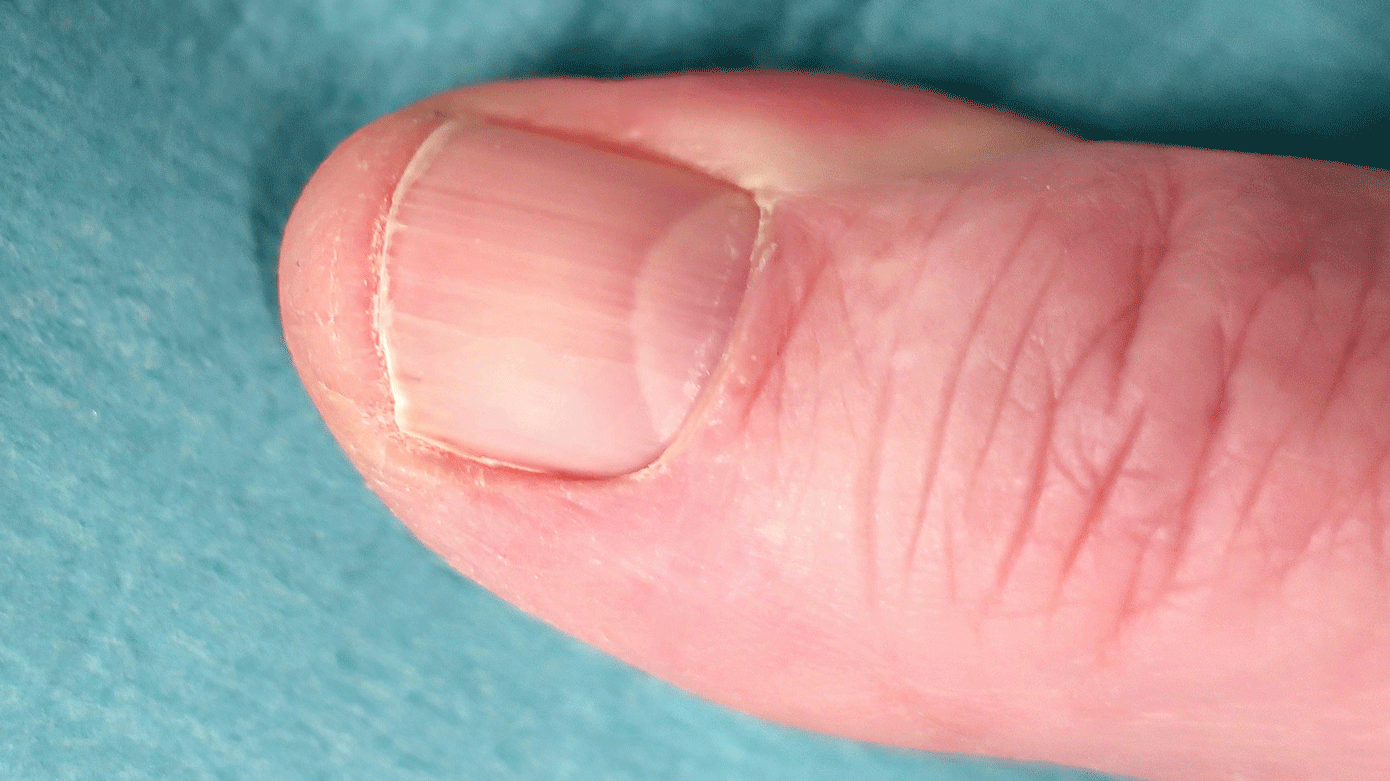 Akutte fingerspidsskader og negleskader på hånden | Ugeskriftet.dk