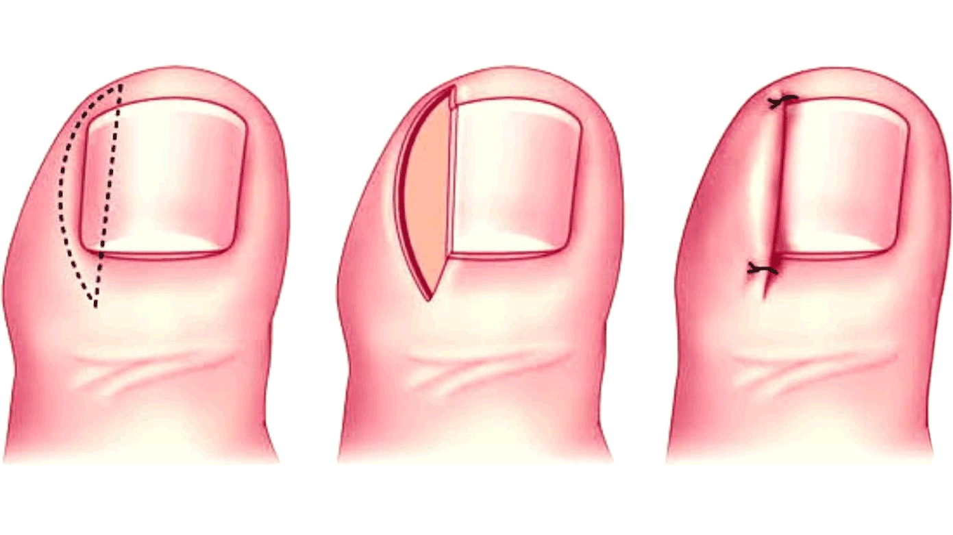 Nedgroet tånegl | Ugeskriftet.dk