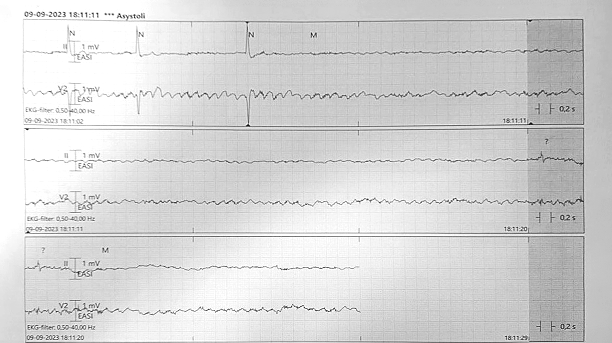 Iktal asystoli er en sjælden komplikation til epilepsi | Ugeskriftet.dk