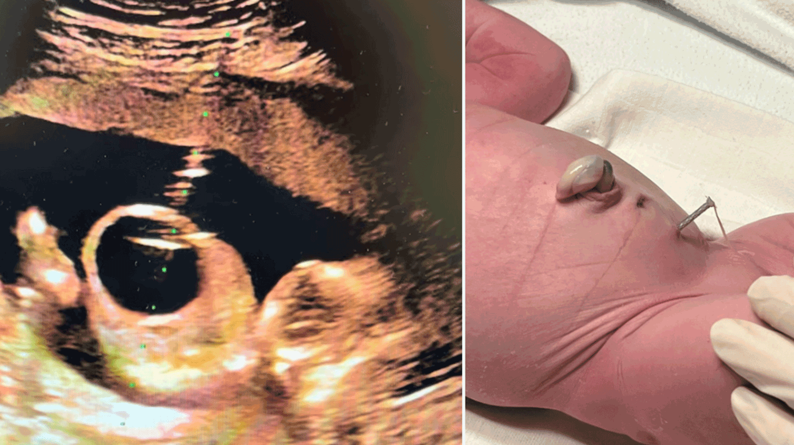 Invasiv behandling af fostre i Danmark | Ugeskriftet.dk