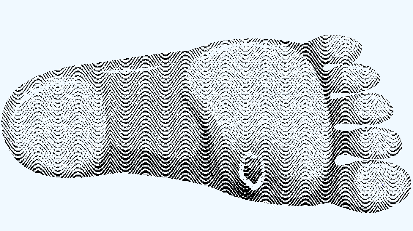 Verrukøst karcinom kan imitere persisterende fodvorter med falsk ...