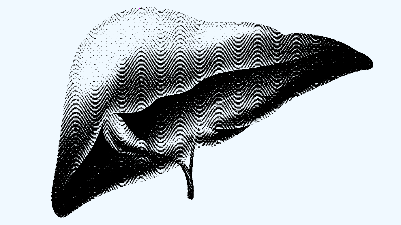 Hepatocellulære adenomer | Ugeskriftet.dk