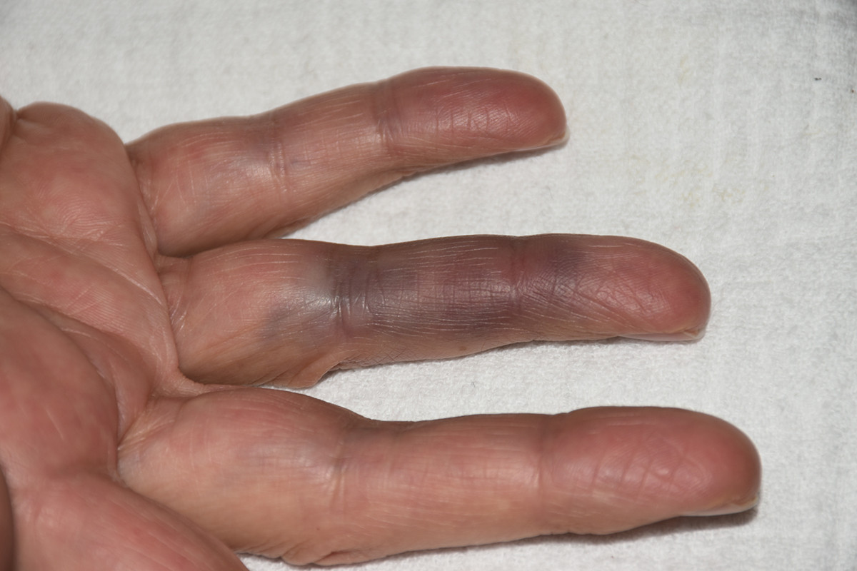 Achenbachs syndrom | Ugeskriftet.dk