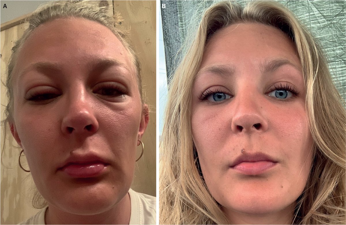 Allergisk reaktion udløst af græshoppe | Ugeskriftet.dk