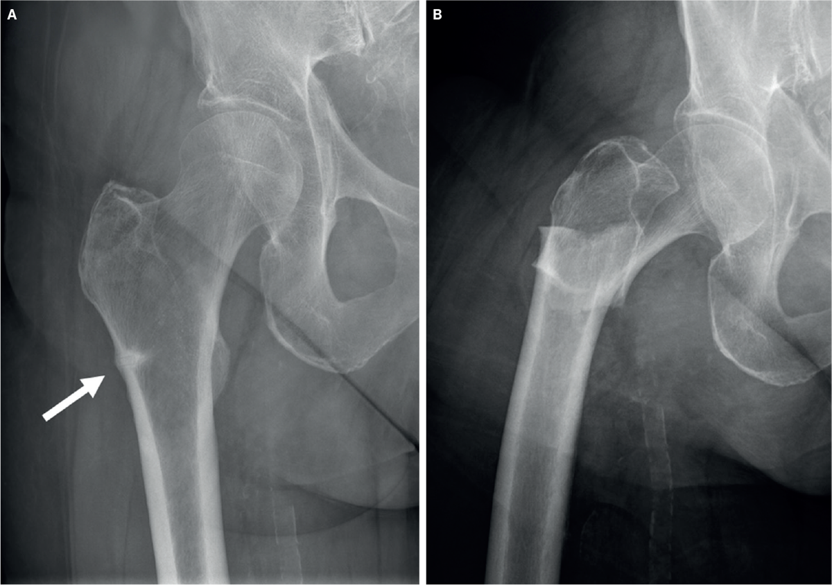 Inkomplet atypisk femurfraktur | Ugeskriftet.dk