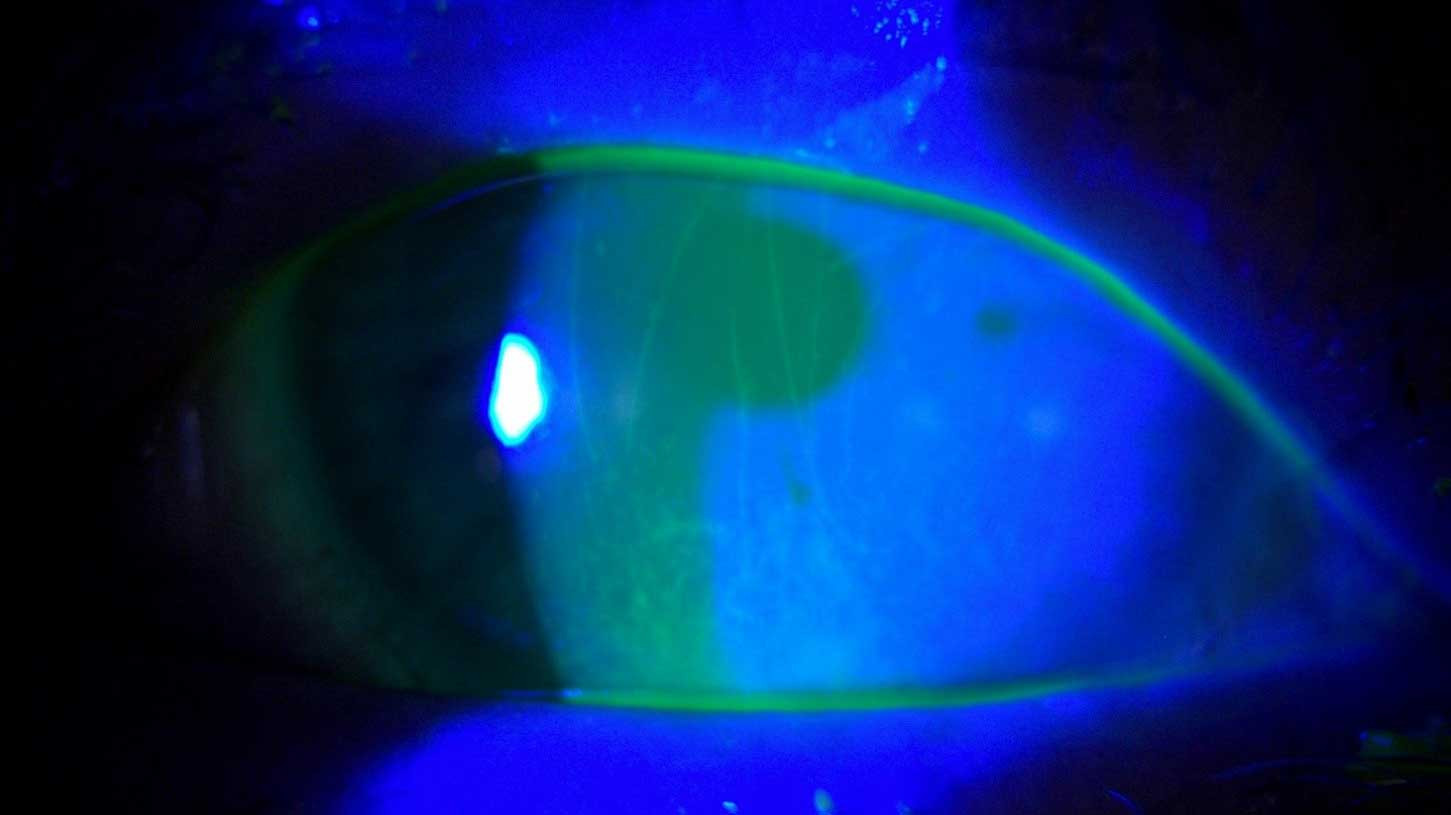 Atypisk udseende korneal abrasion | Ugeskriftet.dk