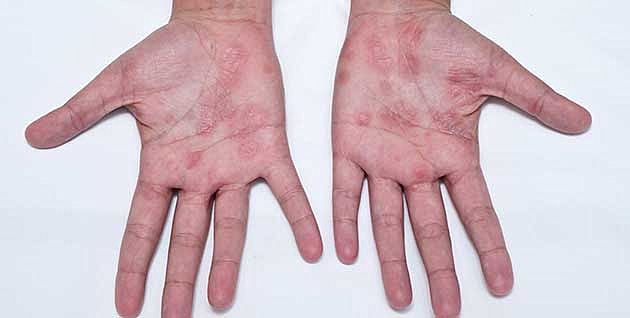 Stigning i tilfælde af syfilis skyldes usikker sex | Ugeskriftet.dk