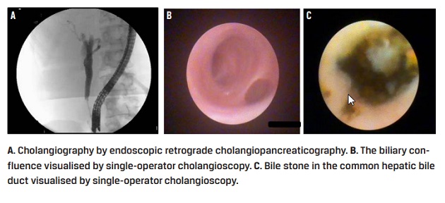 SOC seems to be a useful extension of ERCP during diagnostic work-up ...