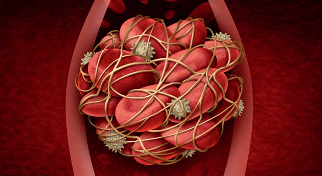 Optimal varighed af antikoagulerende behandling efter dyb venetrombose ...