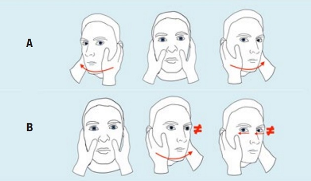 HINTS er et rigtigt godt fif til udredning af akut svimmelhed ...