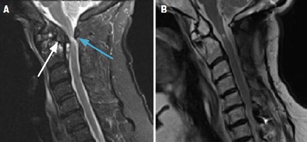 Sjælden og behandlelig årsag til spastisk tetraparese | Ugeskriftet.dk