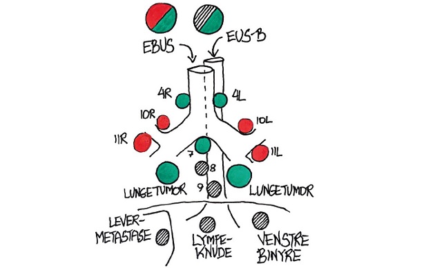 Endoskopisk ultralydskanning via trachea og øsofagus i samme seance til ...