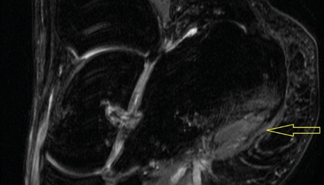 Patologisk senepåvirkning som følge af makrolidbehandling | Ugeskriftet.dk