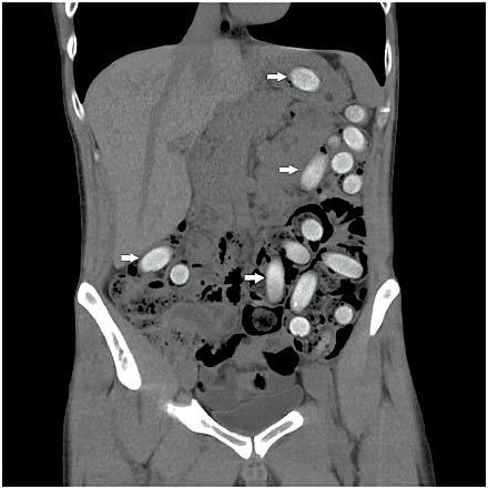 Asymptomatiske body packers bør behandles konservativt | Ugeskriftet.dk