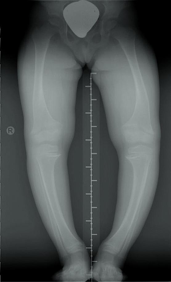 Medicinsk behandling af hypofosfatæmisk rakitis hos børn | Ugeskriftet.dk