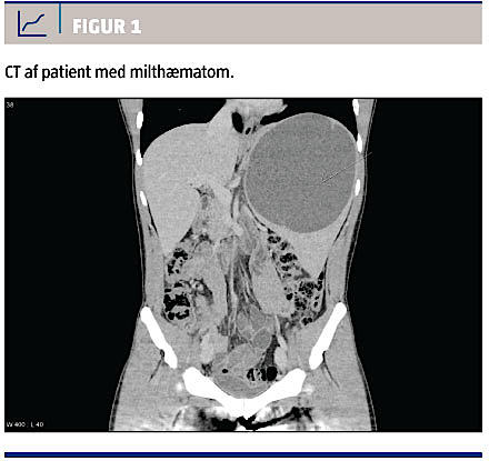 Diagnostik og behandling af stumpe milttraumer | Ugeskriftet.dk