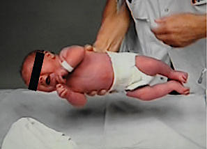 Stiff baby syndrome er en sjælden årsag til neonatal hypertonicitet ...