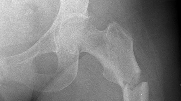 Atypisk femurfraktur hos en kvinde i behandling med lamotrigen ...