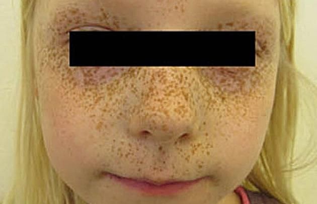 Fregner kan være tegn på genetisk syndrom | Ugeskriftet.dk