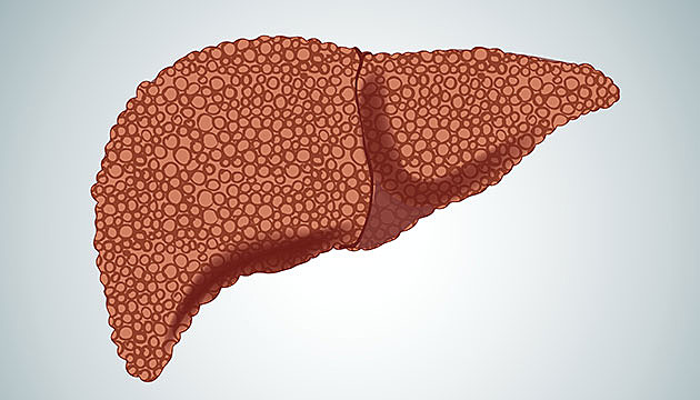 Albumininfusion til dekompenseret levercirrose | Ugeskriftet.dk