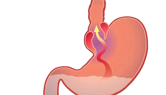 Behandling af gastroøsofagealt reflux og risiko for spiserørskræft ...