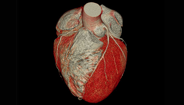 Stress og risiko for hjerte-kar-sygdom | Ugeskriftet.dk
