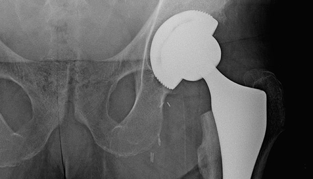 Behandling med paracetamol og ibuprofen til postoperative smerter efter ...