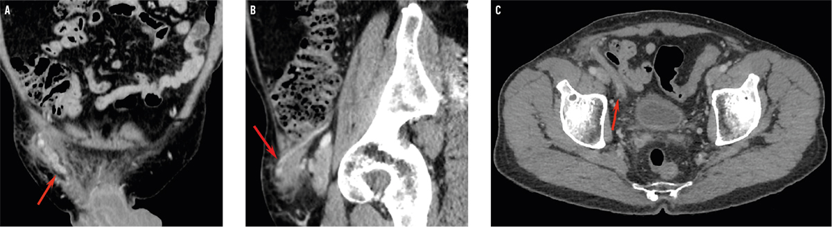 Infektiøs vasitis som differentialdiagnose til ingvinalhernie ...