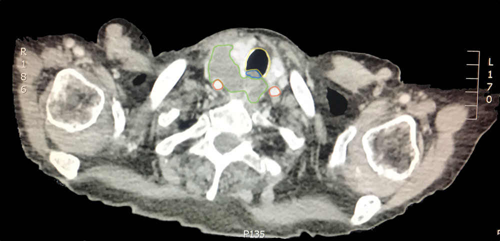 Retroøsofageal absces efter steroidinjektion i sternoklavikulærleddet ...