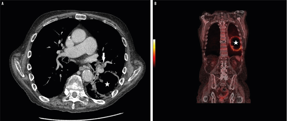 Lungeabsces sekundært til aseptisk lungeemboli | Ugeskriftet.dk