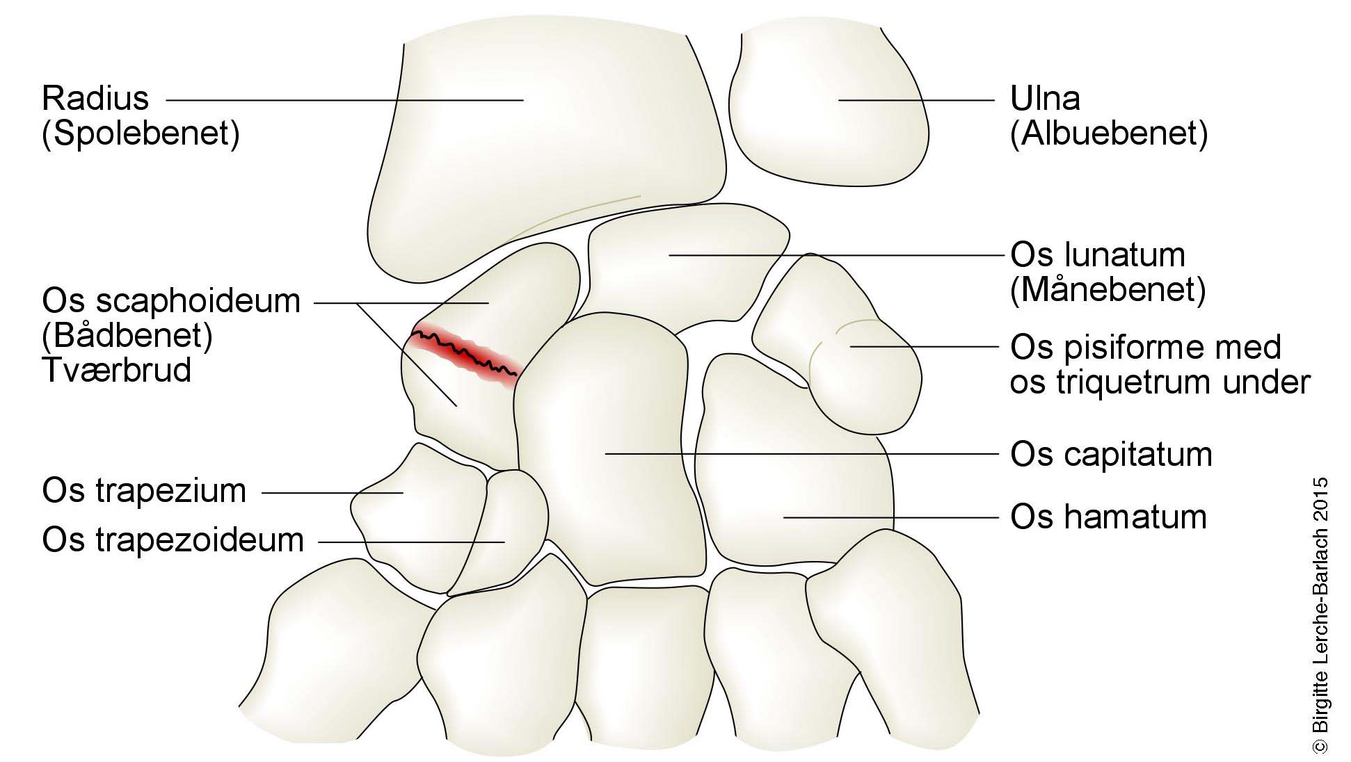 Gipsbandage versus kirurgi til scaphoideumfraktur | Ugeskriftet.dk