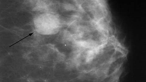 Komplikationer efter mastektomi med primær brystrekonstruktion er ...