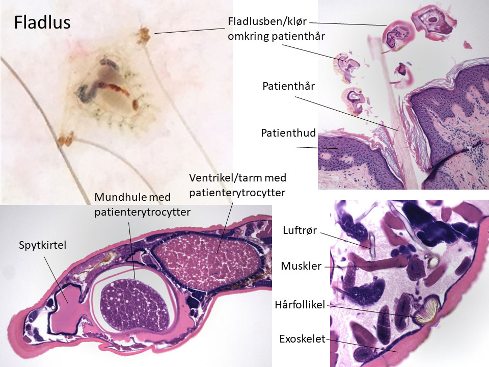Fladlus på flugt | Ugeskriftet.dk