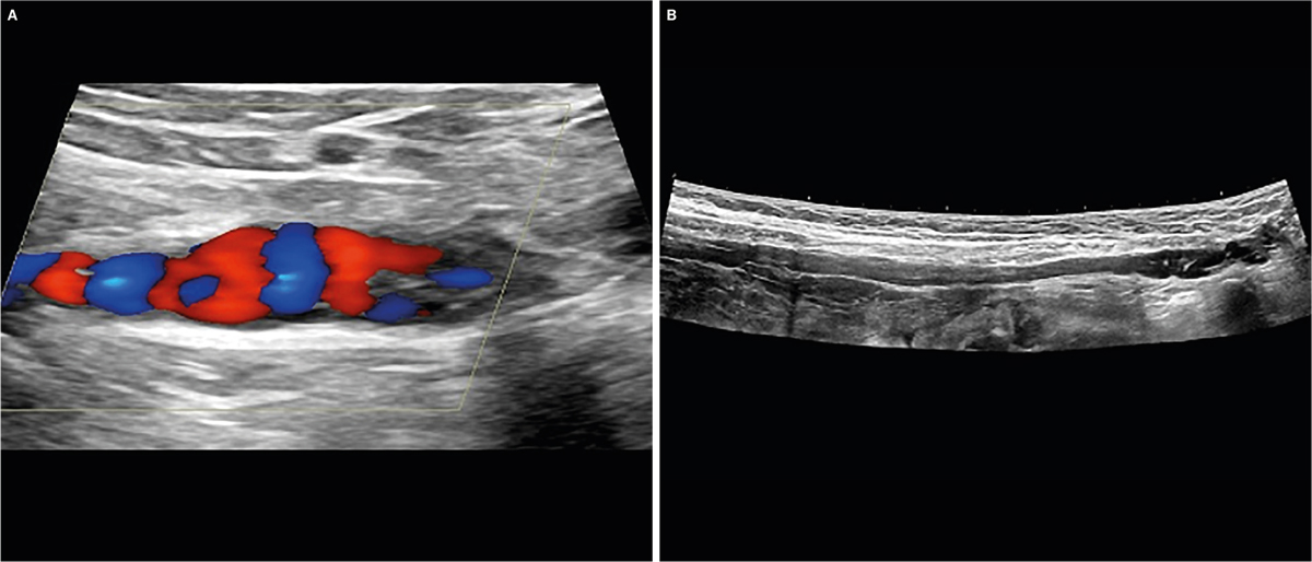 Ligamentumrotundum-varicer er en vigtig differentialdiagnose til ...