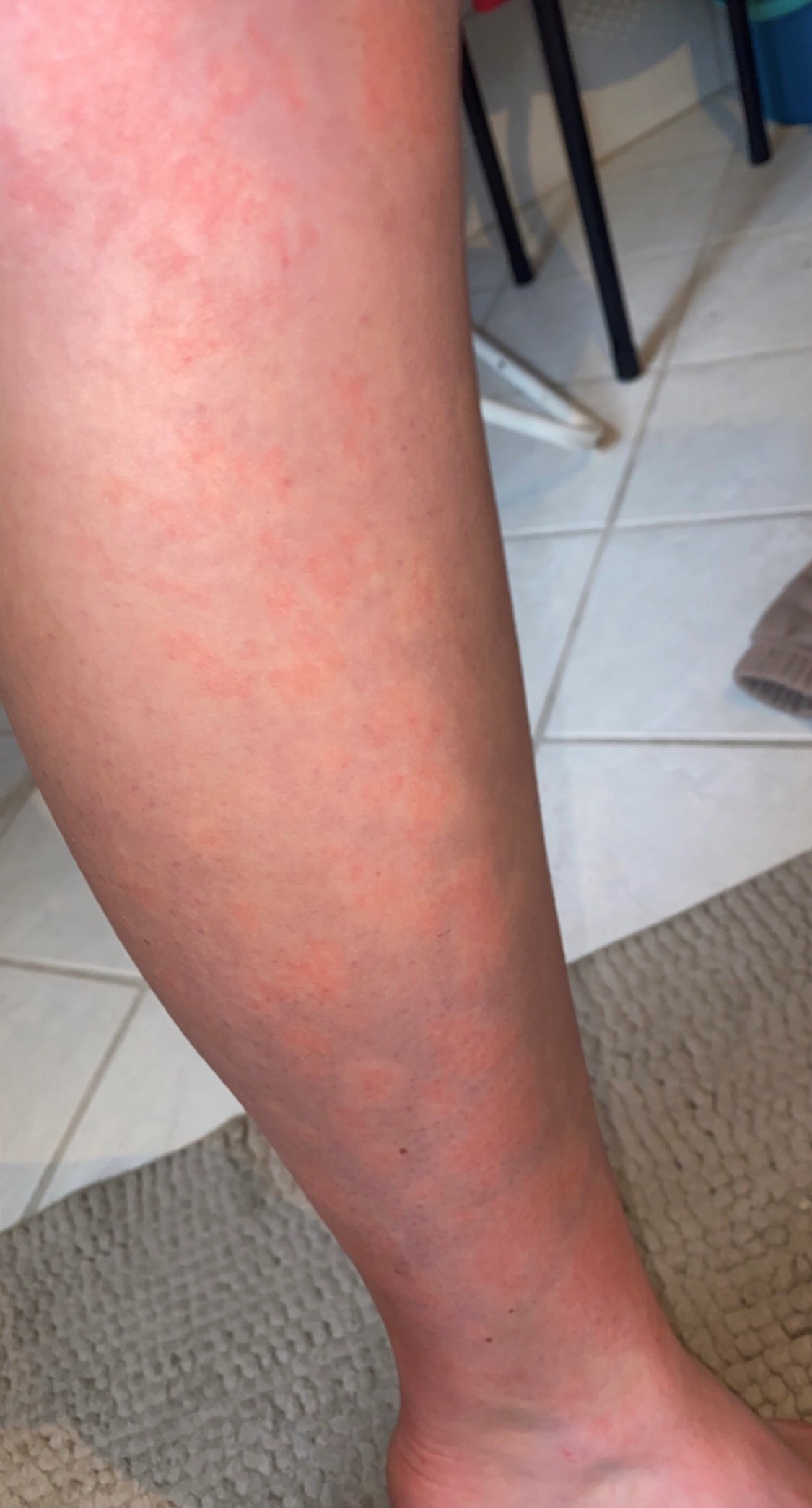 BASCULE syndrom | Ugeskriftet.dk