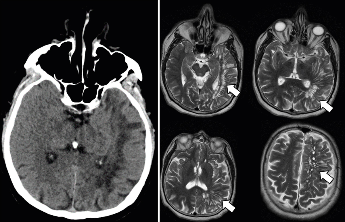 Udvidede perivaskulære rum | Ugeskriftet.dk