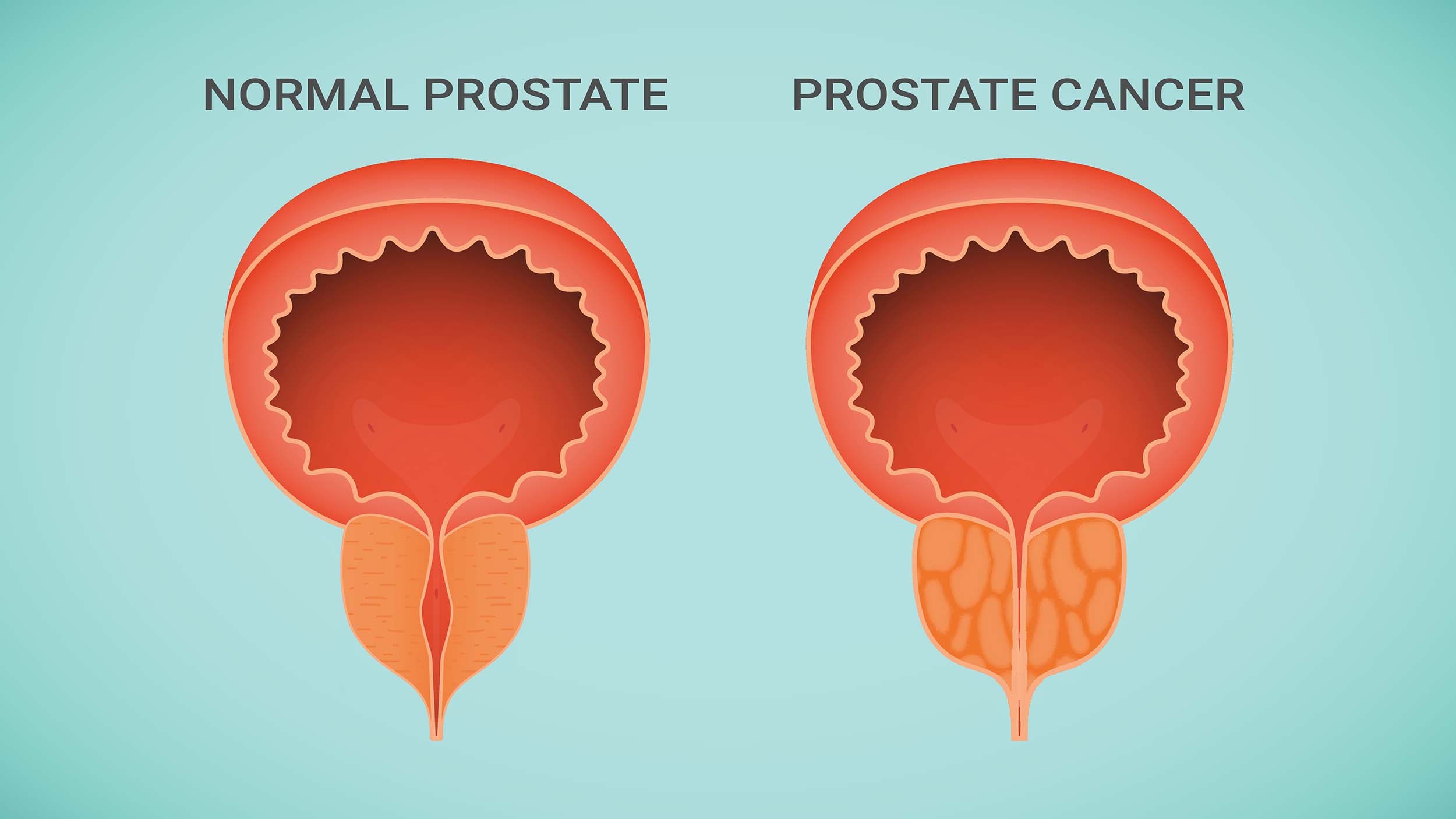 Maksimal androgenblokade til patienter med lokalavanceret ...