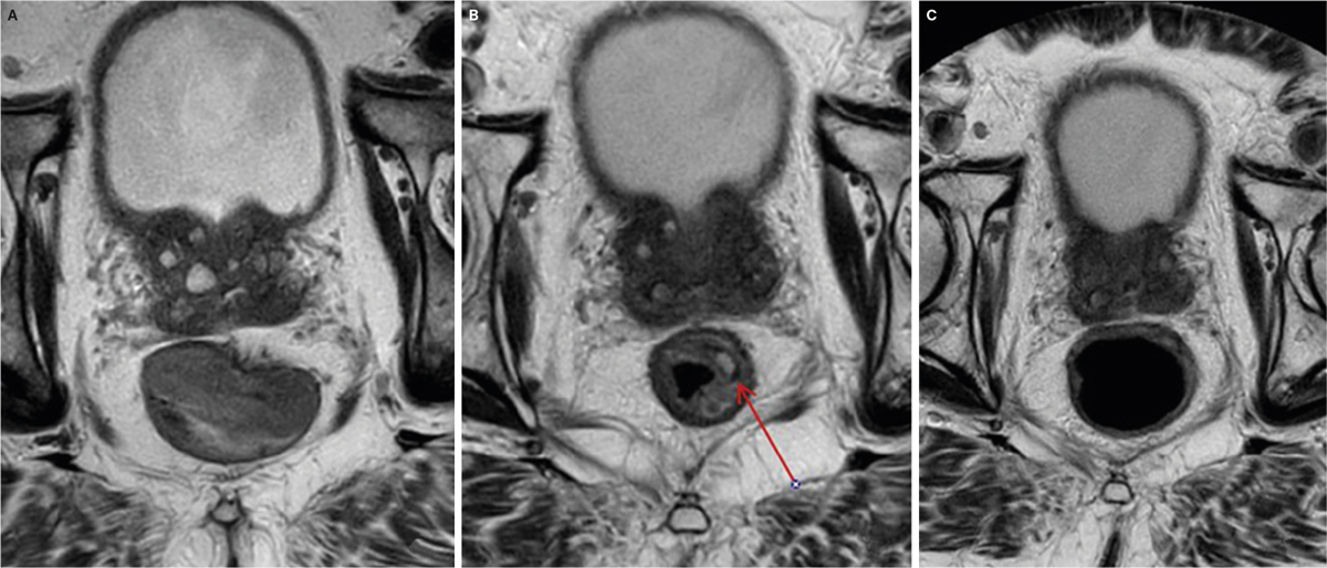 Split scar sign ved rectumcancer | Ugeskriftet.dk