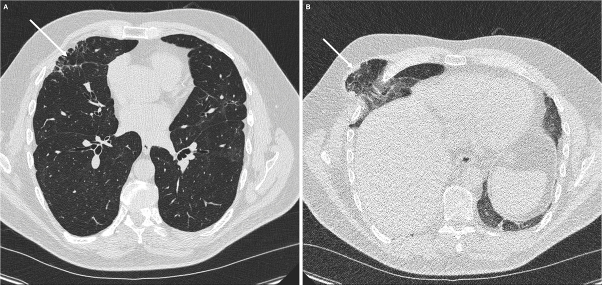 Lungehernie som årsag til fibrose | Ugeskriftet.dk