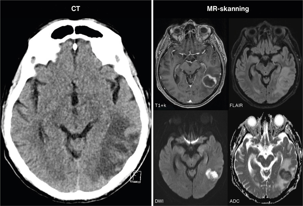 Cerebral absces er en svær diagnose | Ugeskriftet.dk