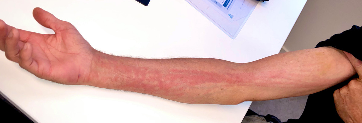 Recidiverende herpes simplex-virus-lymfangitis | Ugeskriftet.dk